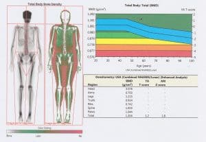 Analyzing Your Body Composition With The Dexa Scan Test: An Honest ...